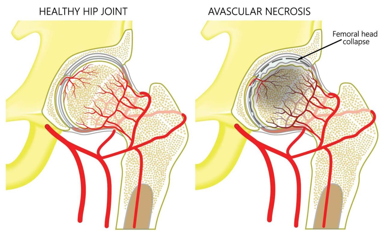 Hip Osteonecrosis: Private Treatment in Gloucestershire